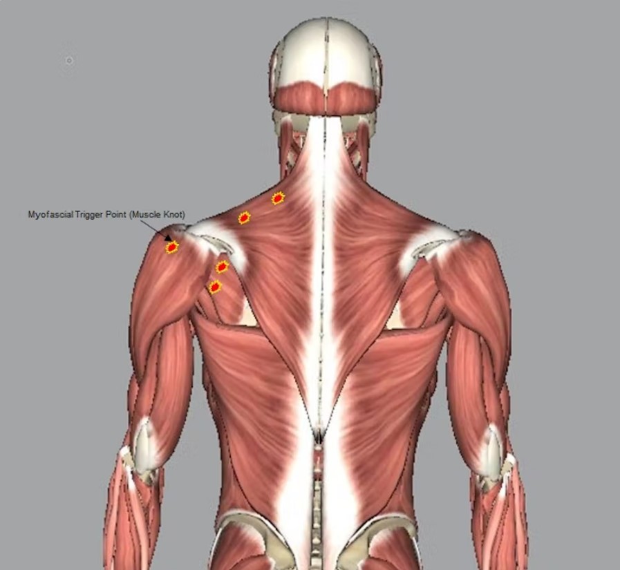 What are muscle knots? An exercise physiologist explains - Big Think